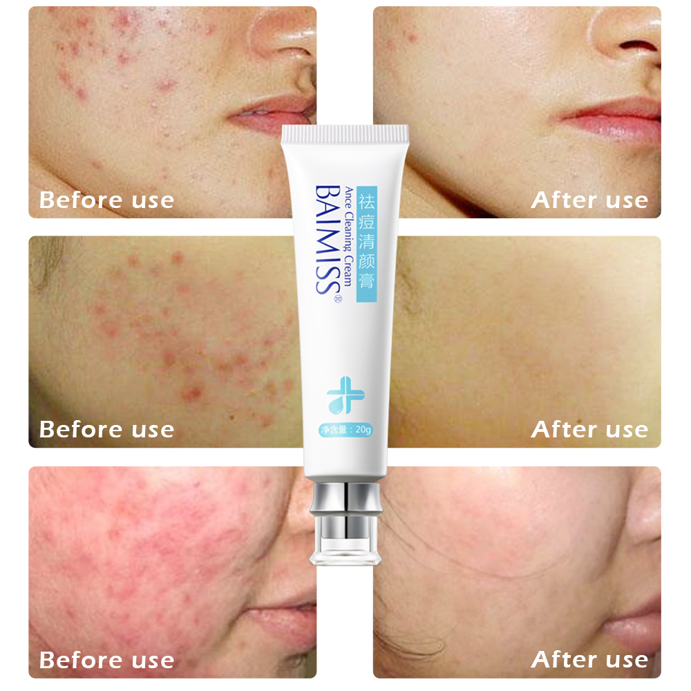 BAIMISS Krim Wajah Anti Acne 20g - JakartaNotebook.com